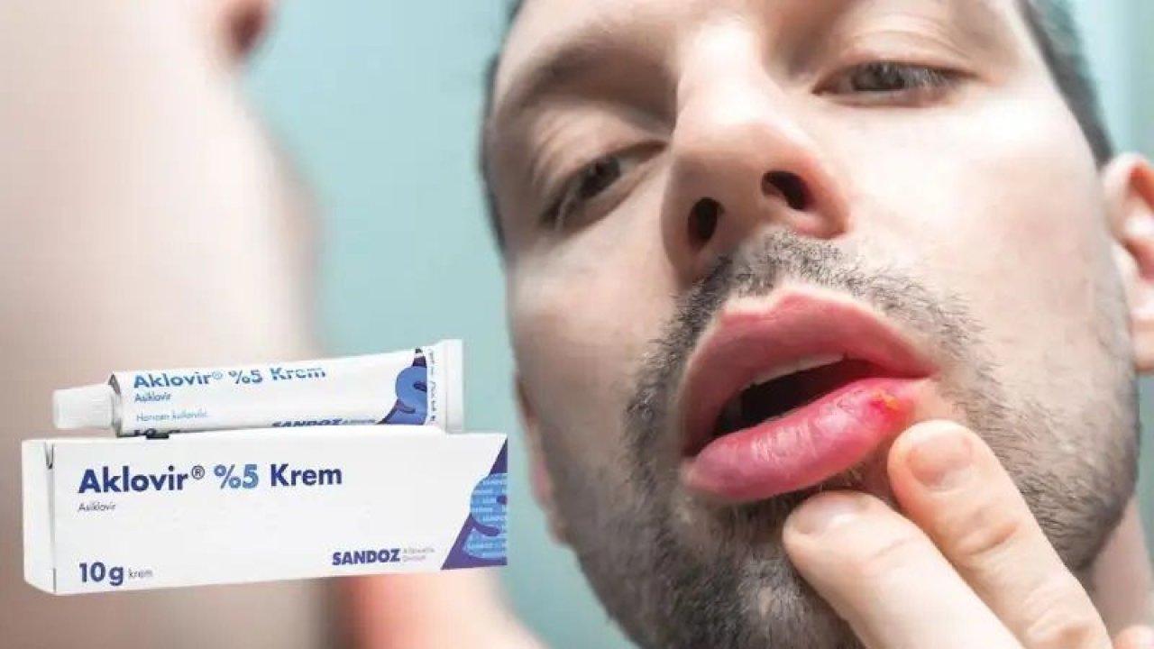 Aklovir Krem Ne İşe Yarar, Ne İçin Kullanılır, Fiyatı Ne Kadar?